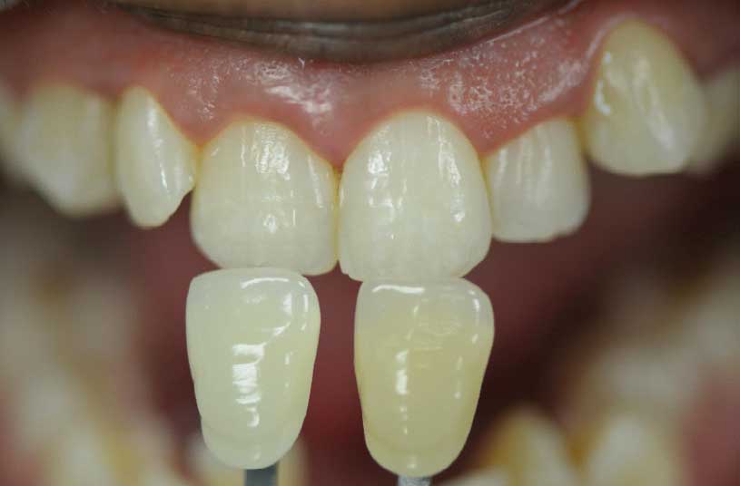 0322-esthetics-03 - Dimensions of Dental Hygiene | Magazine