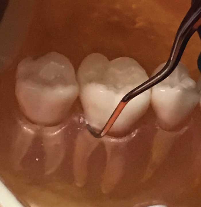 extend-reach-4 - Dimensions of Dental Hygiene | Magazine