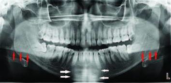 X-ray figure 5 New - Dimensions of Dental Hygiene | Magazine