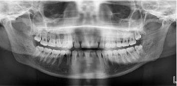 X-ray figure 9 New - Dimensions of Dental Hygiene | Magazine