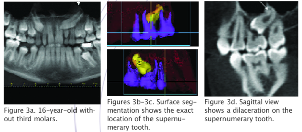 Radiography and the Mixed Dentition - Dimensions of Dental Hygiene