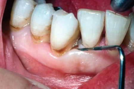 Key to Effective Calculus Removal - Dimensions of Dental Hygiene