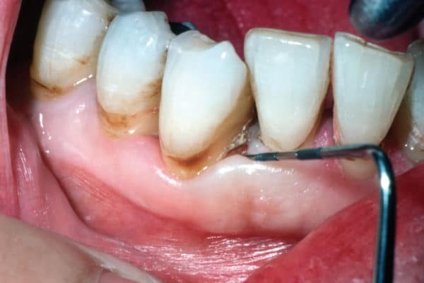 Key to Effective Calculus Removal - Dimensions of Dental Hygiene