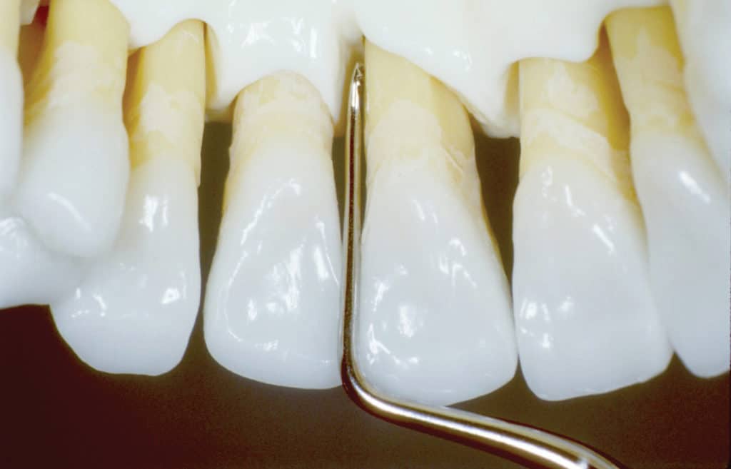 Key to Effective Calculus Removal - Dimensions of Dental Hygiene