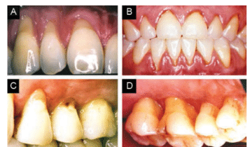The Root of Dentinal Hypersensitivity - Dimensions of Dental Hygiene