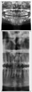 Best Practices for Pediatric Dental Radiography - Dimensions of Dental ...