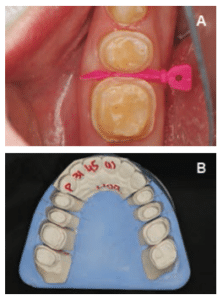 Severe Tooth Wear: A Case Report - Dimensions of Dental Hygiene
