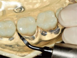 Adapting Site-Specific Ultrasonic Inserts/Tips