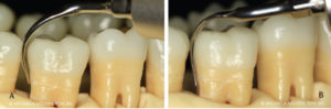 Adapting Site-Specific Ultrasonic Inserts/Tips