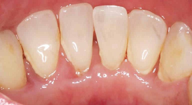 Successful Strategies for Periodontal Debridement