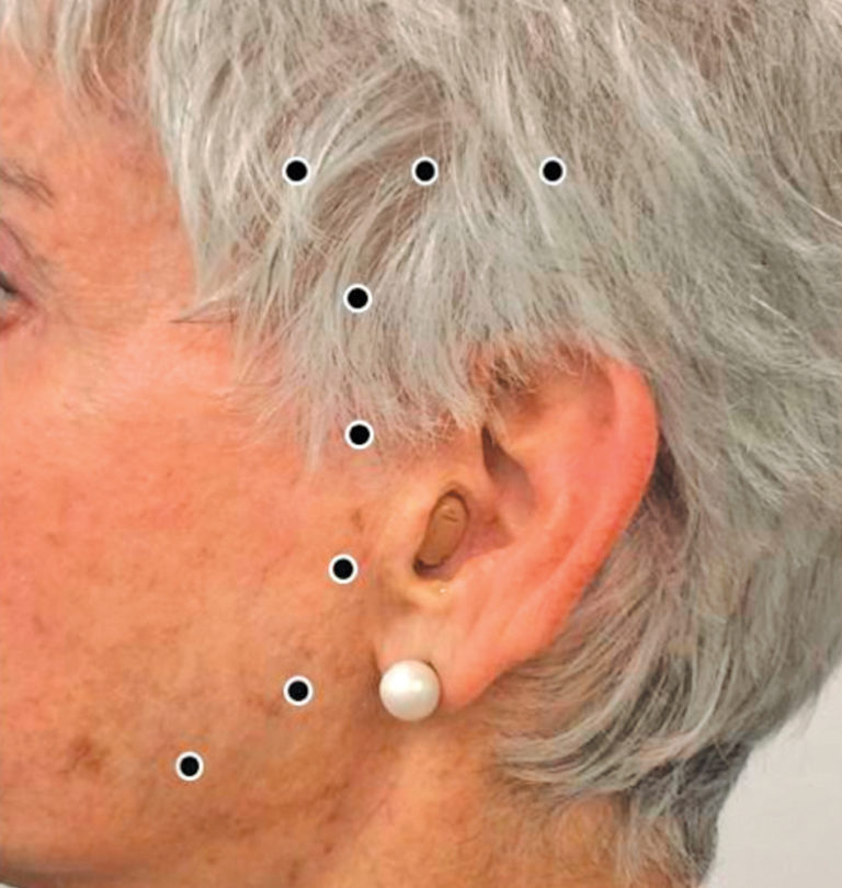 The Therapeutic Use of Botox - Dimensions of Dental Hygiene