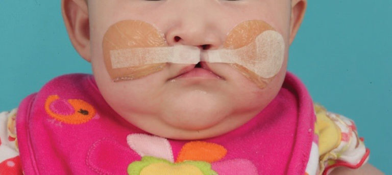 The Treatment of Cleft Lip and/or Palate - Dimensions of Dental Hygiene