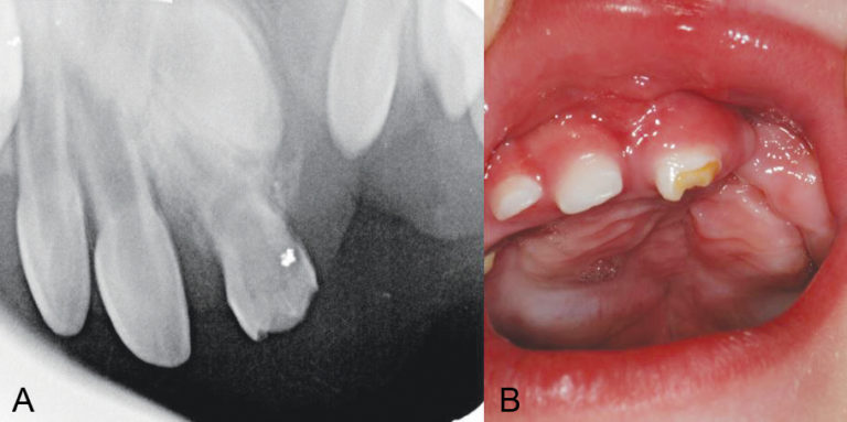 The Treatment of Cleft Lip and/or Palate - Dimensions of Dental Hygiene