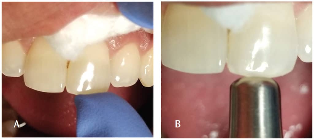 Endodontic Diagnosis for the Dental Hygienist