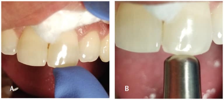 Endodontic Diagnosis for the Dental Hygienist