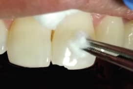 Endodontic Diagnosis for the Dental Hygienist