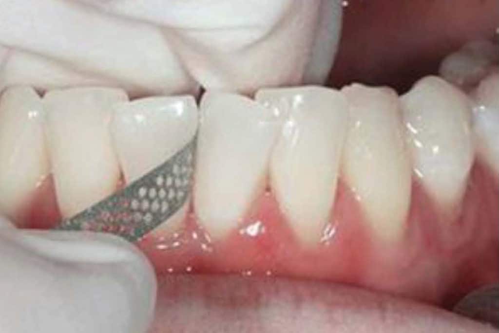 Hypersensitivity in the Orthodontic Patient