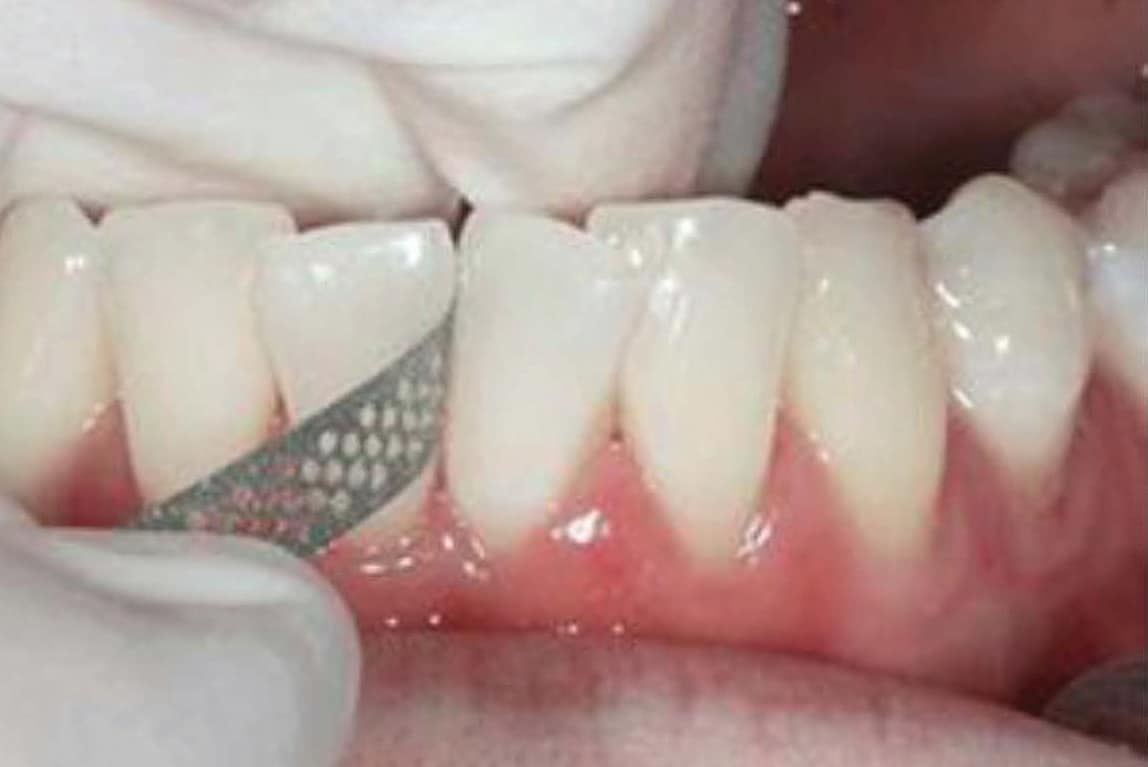 Hypersensitivity in the Orthodontic Patient