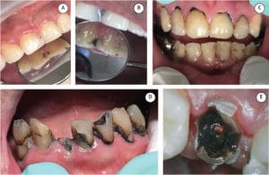 Incorporating the Use of Silver Diamine Fluoride - Dimensions