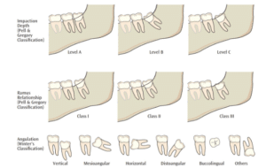 Third Molars Extraction Conundrum-Dimensions of Dental Hygiene