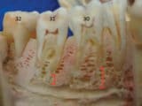 The Use of Periodontal Ligament Injections