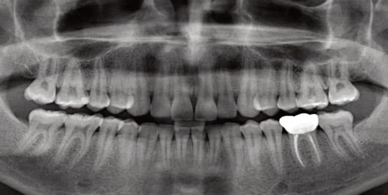 The Use of Periodontal Ligament Injections