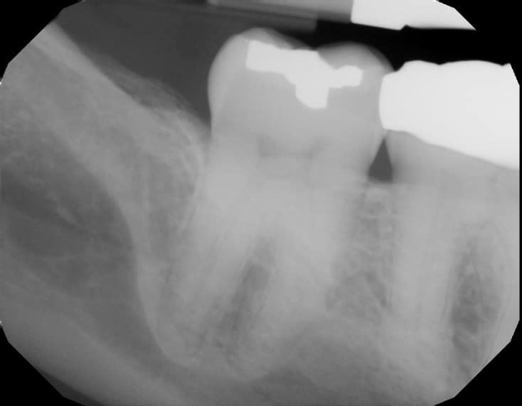 The Use of Periodontal Ligament Injections