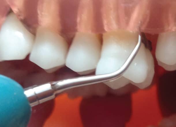 Ultrasonic Insert/Tip Selection for First Molar Teeth