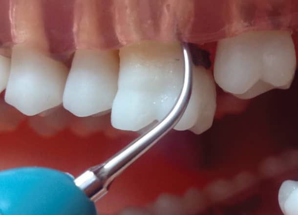 Ultrasonic Insert/Tip Selection for First Molar Teeth