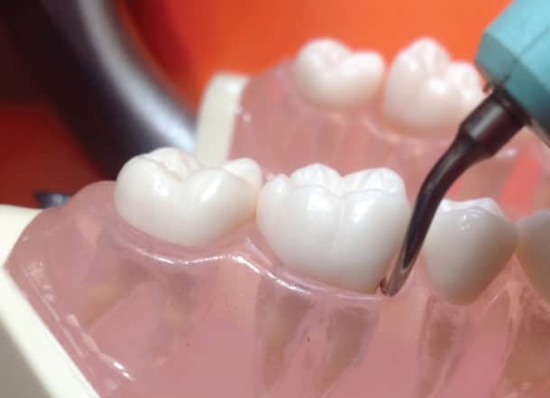 Ultrasonic Insert/Tip Selection for First Molar Teeth