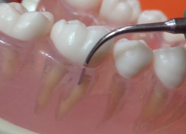 Ultrasonic Insert/Tip Selection for First Molar Teeth