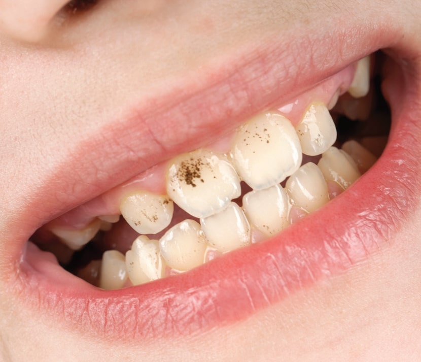 Risks to Oral Health Posed by Swimming - Dimensions of Dental Hygiene