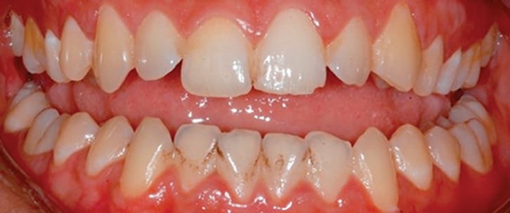 Risks to Oral Health Posed by Swimming - Dimensions of Dental Hygiene