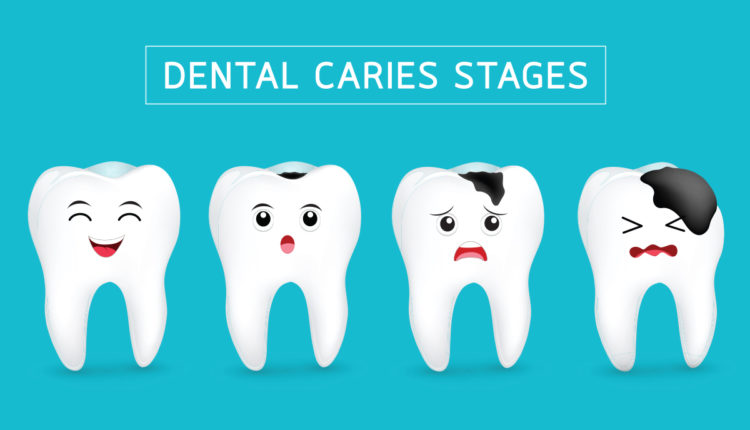 03-2019-W2-S3-3-illustration-caries-stages - Dimensions of Dental Hygiene | Magazine