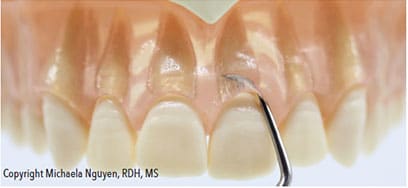 Accessing the Base of the Pocket - Dimensions of Dental Hygiene