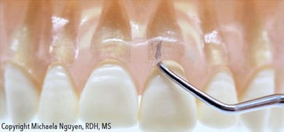 Accessing the Base of the Pocket - Dimensions of Dental Hygiene