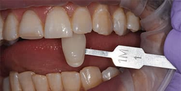 Advancing In-Office Whitening Techniques - Dimensions of Dental Hygiene