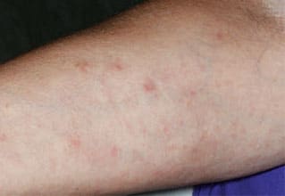 Addressing Drug-Related SCARs - Dimensions of Dental Hygiene