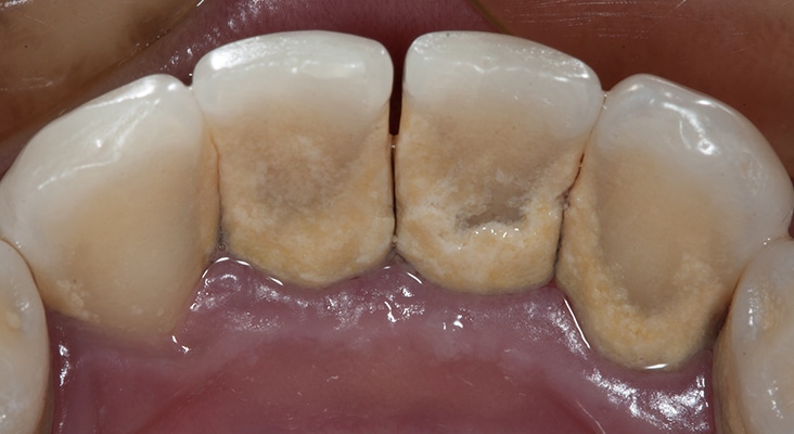 Calculus Detection With the Dental Endoscope - Dimensions of Dental Hygiene
