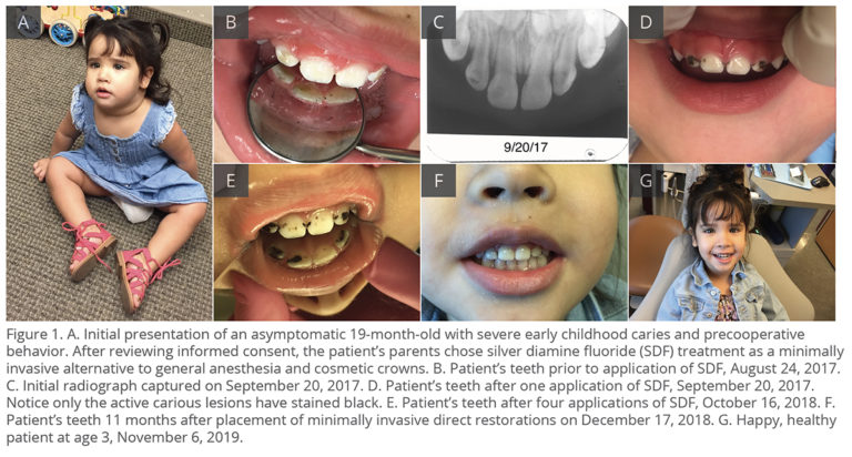 A Practical Guide to Silver Diamine Fluoride - Dimensions of Dental Hygiene