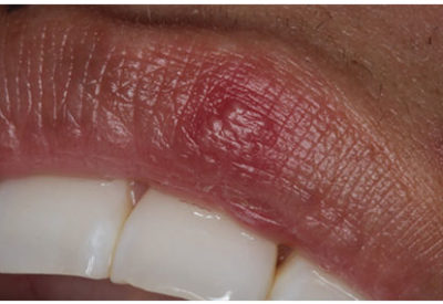 Treating Herpetic Lesions With Laser Therapy