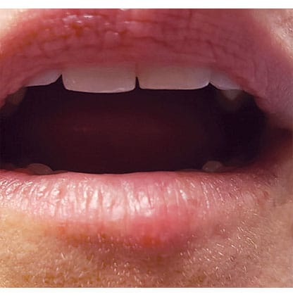 Treating Herpetic Lesions With Laser Therapy