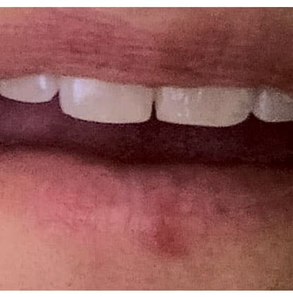 Treating Herpetic Lesions With Laser Therapy