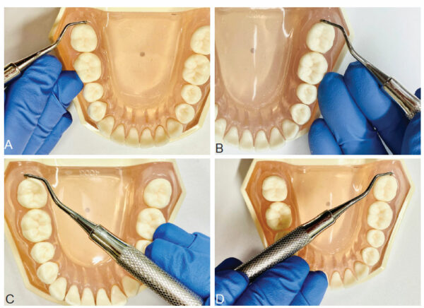 Tackling Terminal Distal Surfaces - Dimensions of Dental Hygiene