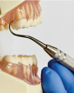 Tackling Terminal Distal Surfaces - Dimensions of Dental Hygiene