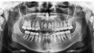 Reduce Your Panoramic Imaging Errors - Dimensions of Dental Hygiene