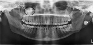 Reduce Your Panoramic Imaging Errors - Dimensions of Dental Hygiene