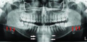 Reduce Your Panoramic Imaging Errors - Dimensions of Dental Hygiene