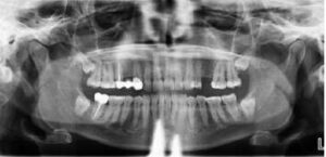 Reduce Your Panoramic Imaging Errors - Dimensions of Dental Hygiene