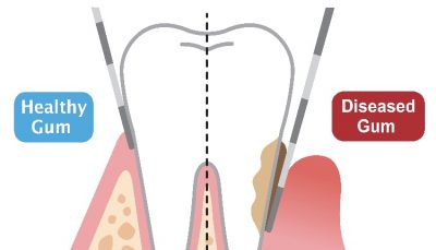 Risk-Based Recare for Perio Maintenance - Dimensions of Dental Hygiene